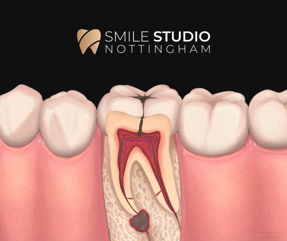 Root Canal Treatment | Private Dental Care Arnold Nottingham